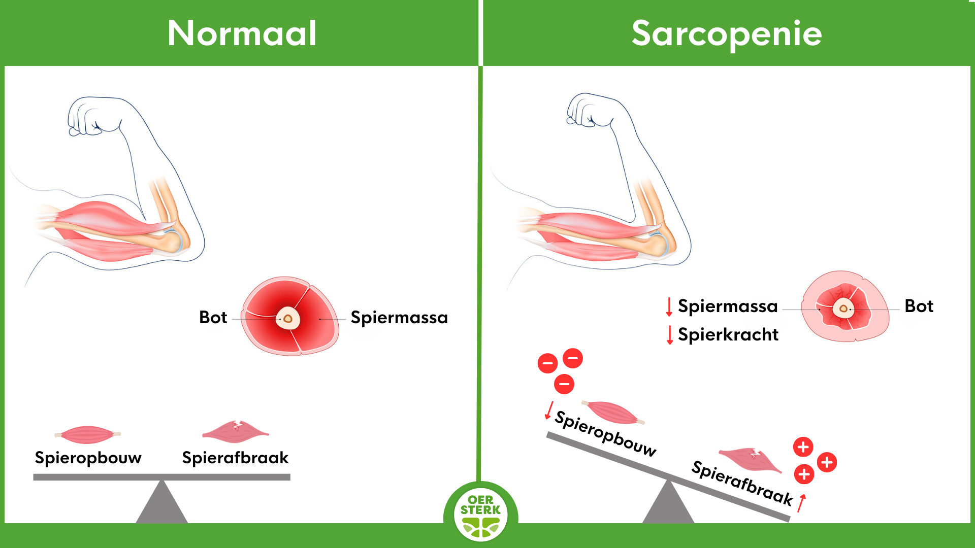 Alles over sarcopenie: symptomen, oorzaken en behandelingen